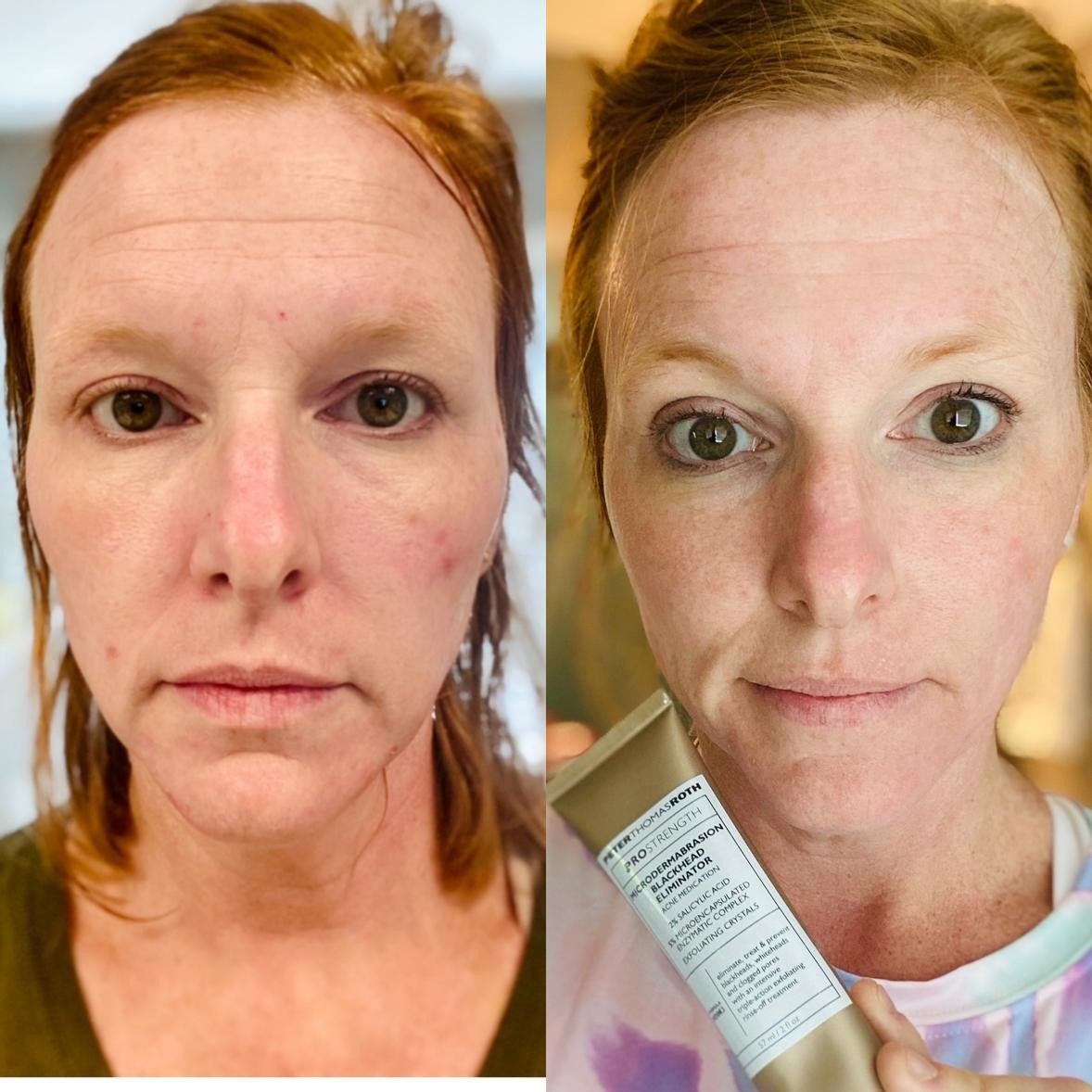 Microdermabrasion Blackheads Before And After